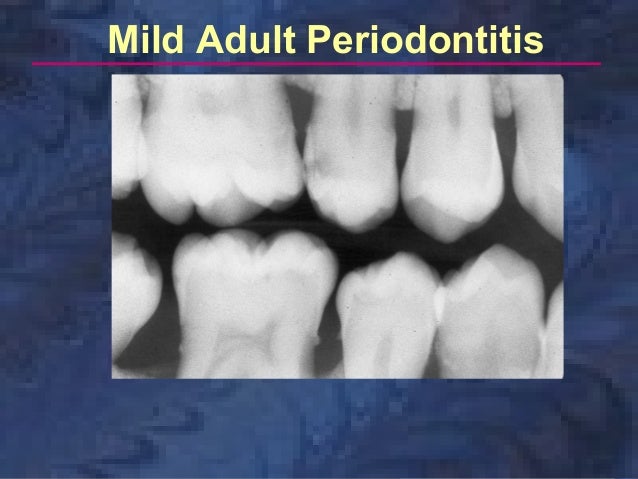 Radiology for periodental diseases