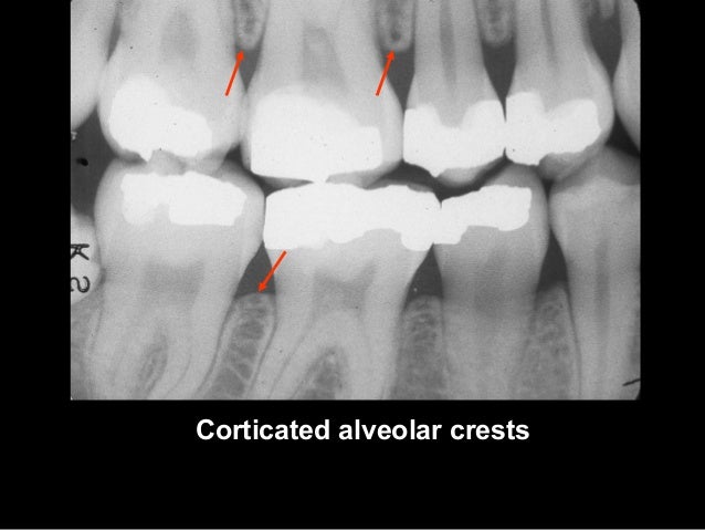 Radiology for periodental diseases