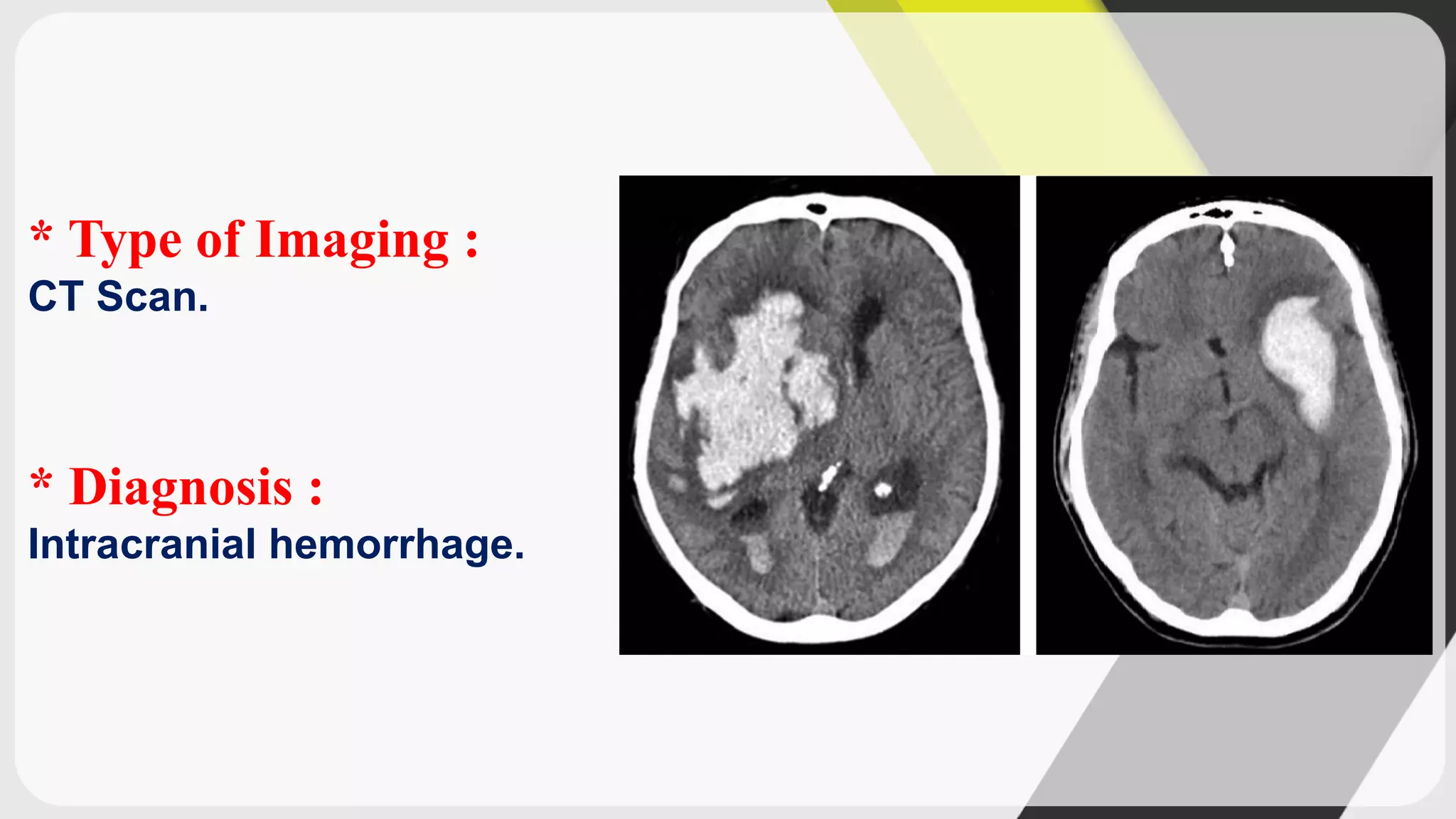 Radiology (imaging of cns disorders) | PDF