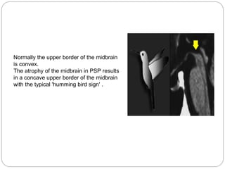 radiology in dementia powerpoint presentation | PPT