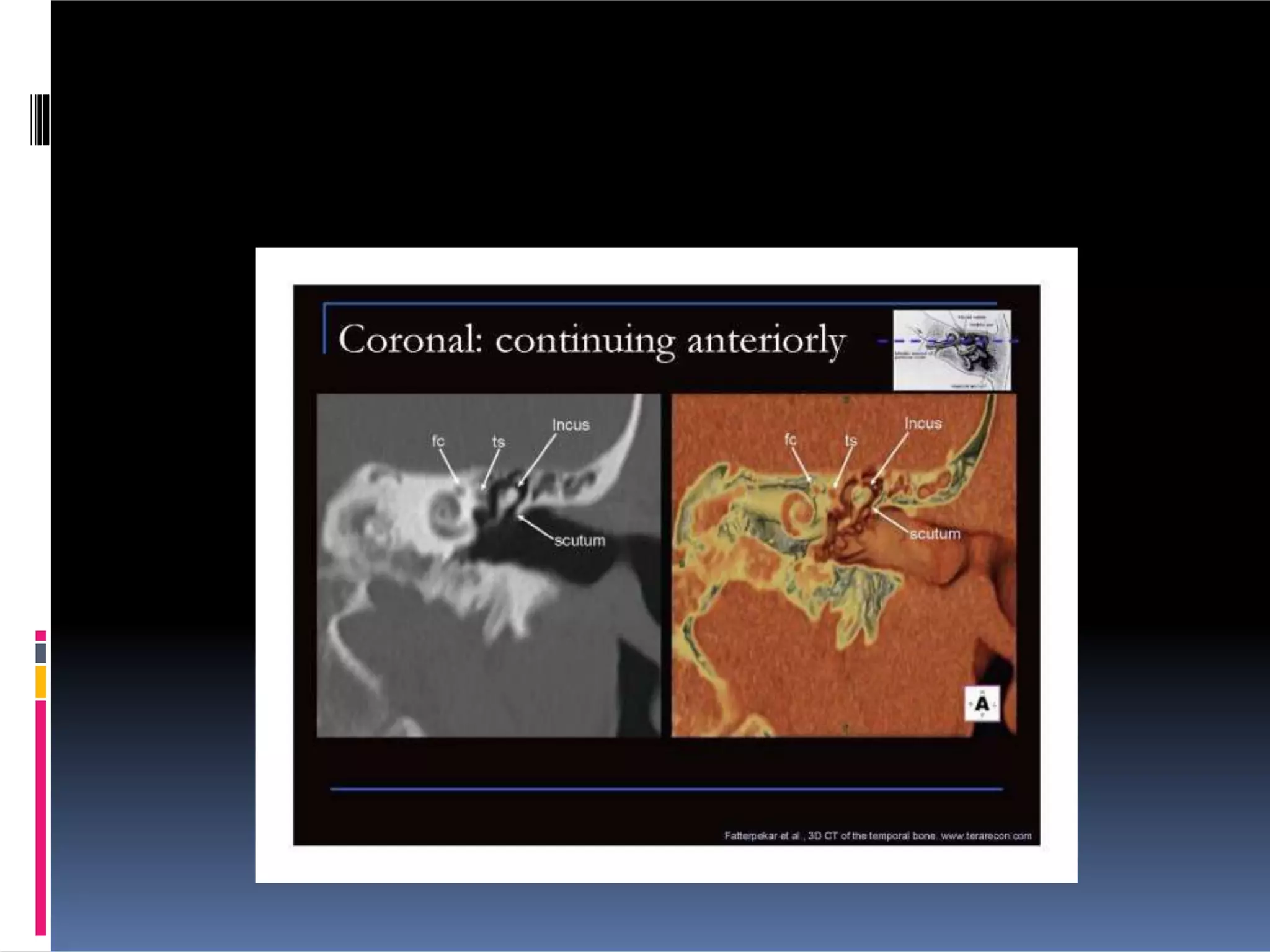 Radiology in ENT | PPTX