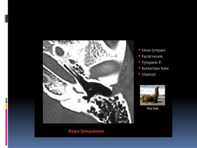 Radiology in ENT | PPTX | Ear, Nose and Throat Conditions | Diseases ...