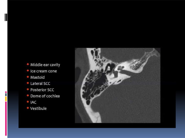 Radiology in ENT | PPTX | Ear, Nose and Throat Conditions | Diseases ...
