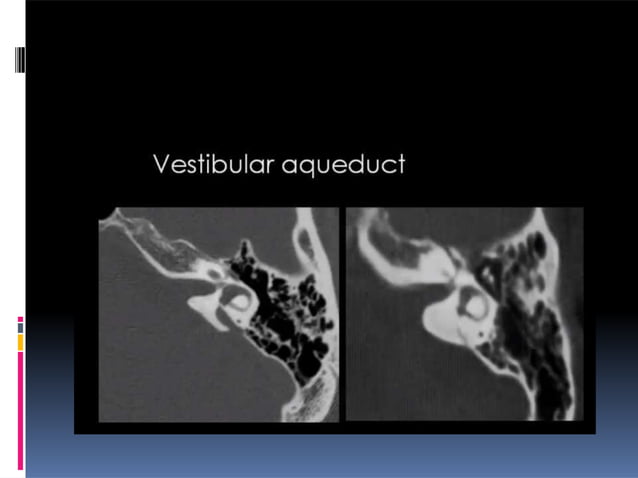 Radiology in ENT | PPTX | Ear, Nose and Throat Conditions | Diseases ...