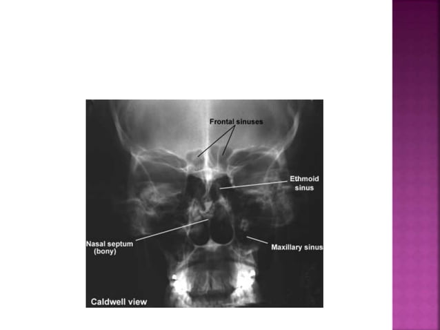 Radiology in ent | PPTX | Ear, Nose and Throat Conditions | Diseases ...