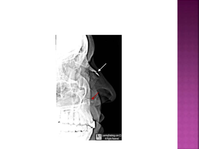 Radiology in ent | PPTX | Ear, Nose and Throat Conditions | Diseases ...