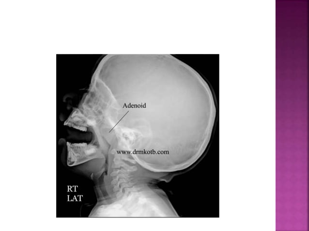 Radiology in ent | PPTX | Ear, Nose and Throat Conditions | Diseases ...