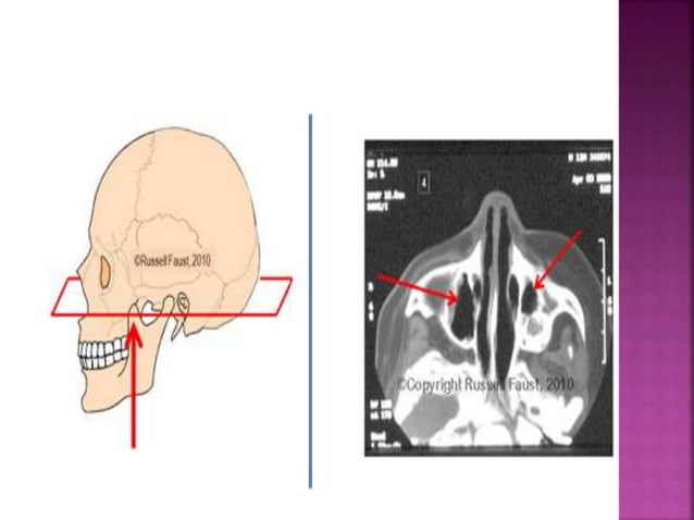 Radiology in ent | PPTX | Ear, Nose and Throat Conditions | Diseases ...