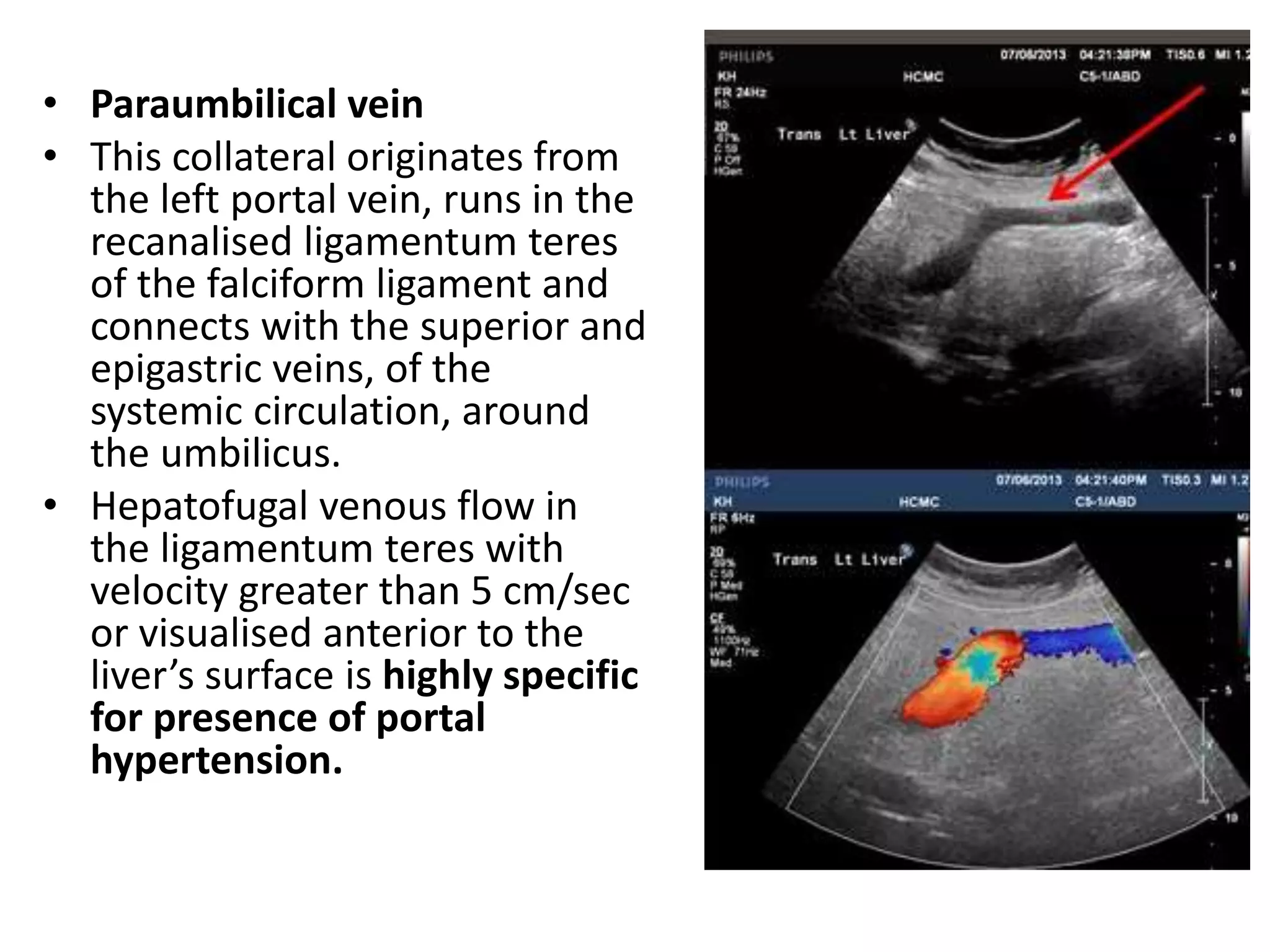 Radiology in portal hypertension | PPTX
