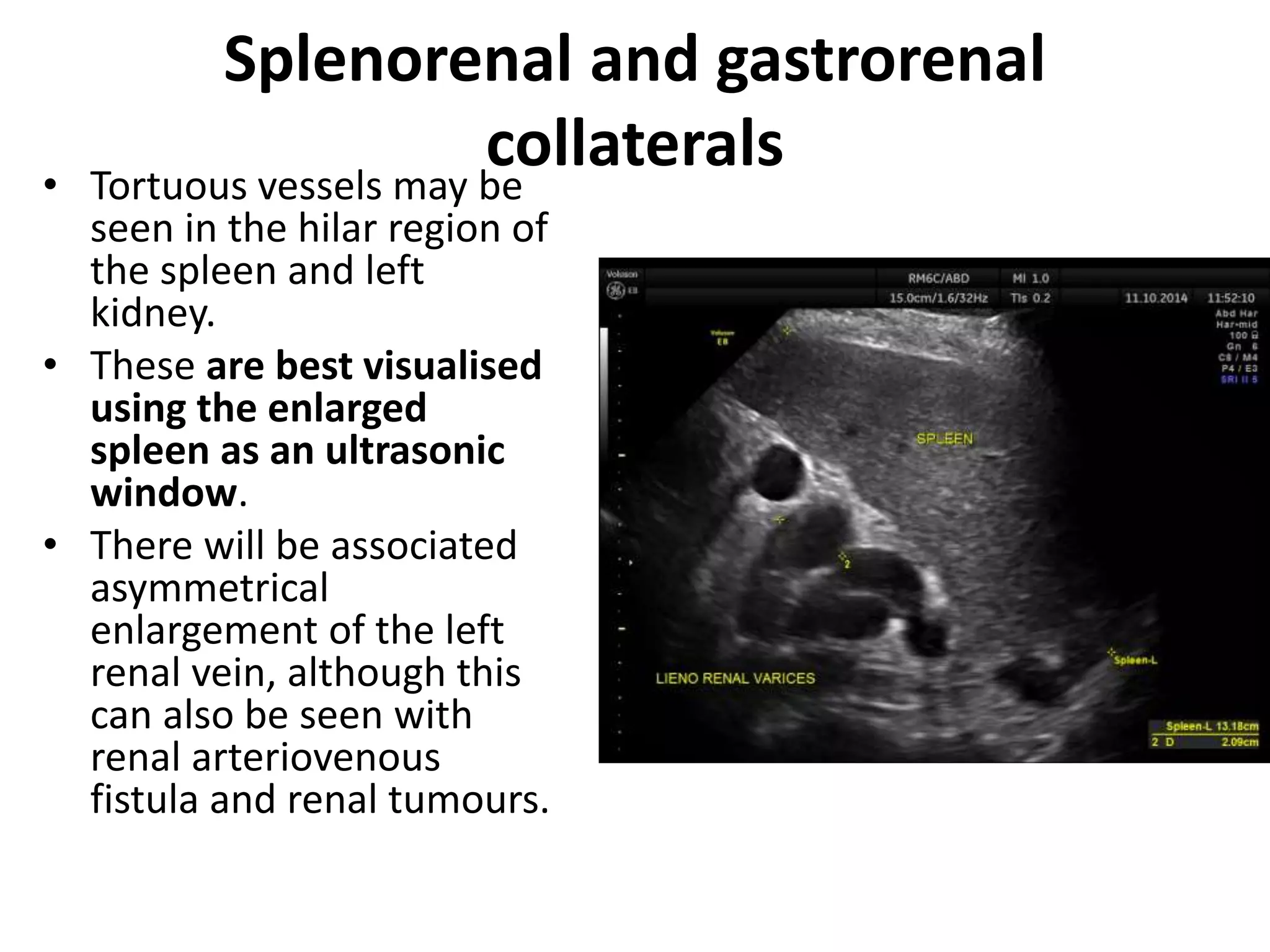 Radiology in portal hypertension | PPTX