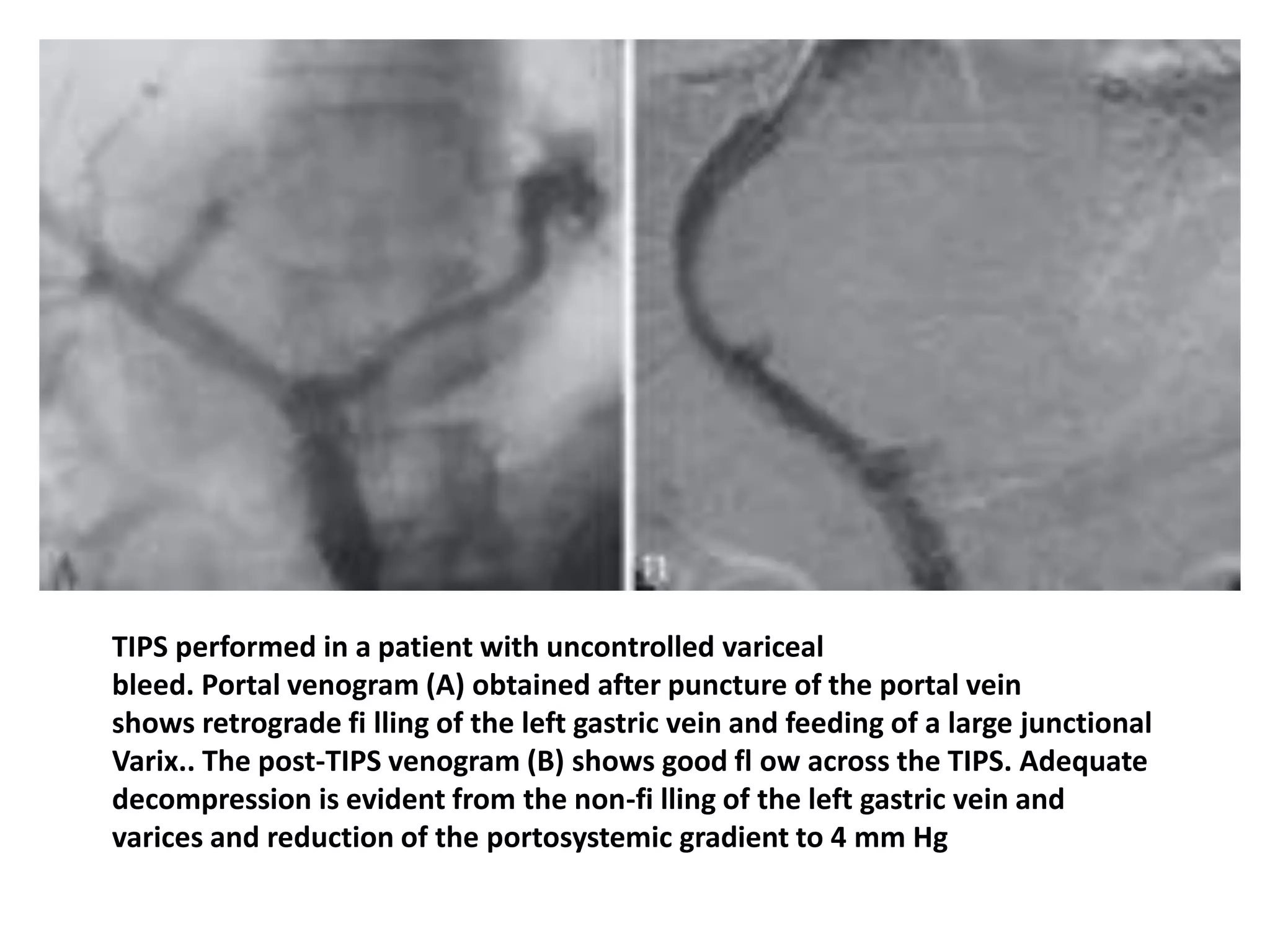 Radiology in portal hypertension | PPTX