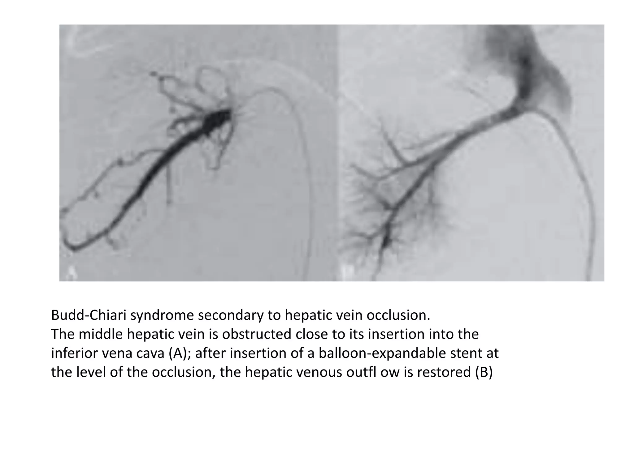 Radiology in portal hypertension | PPTX