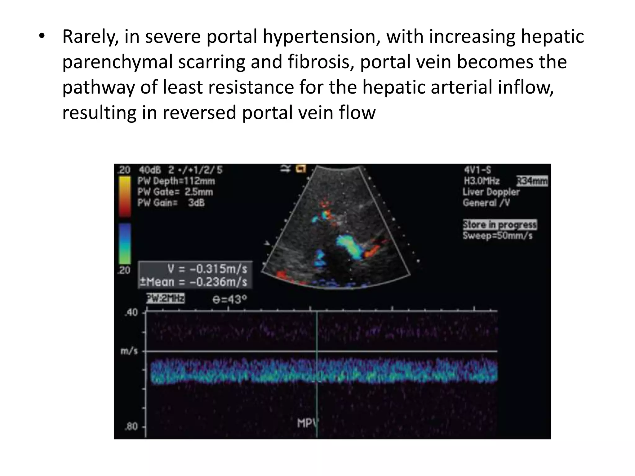Radiology in portal hypertension | PPTX