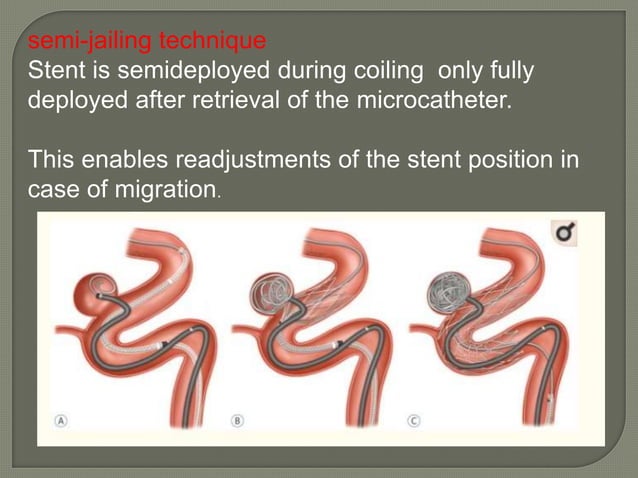 Radiology intervetion neuro | PPTX | First Aid | Injuries