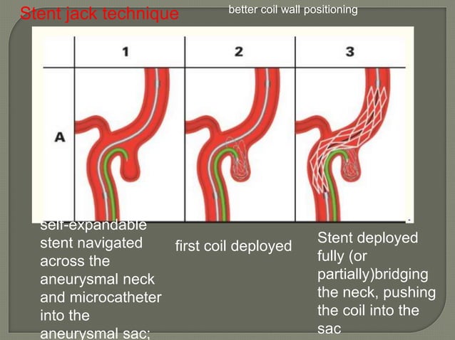 Radiology intervetion neuro | PPTX | First Aid | Injuries
