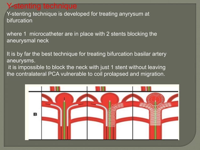 Radiology intervetion neuro | PPTX | First Aid | Injuries