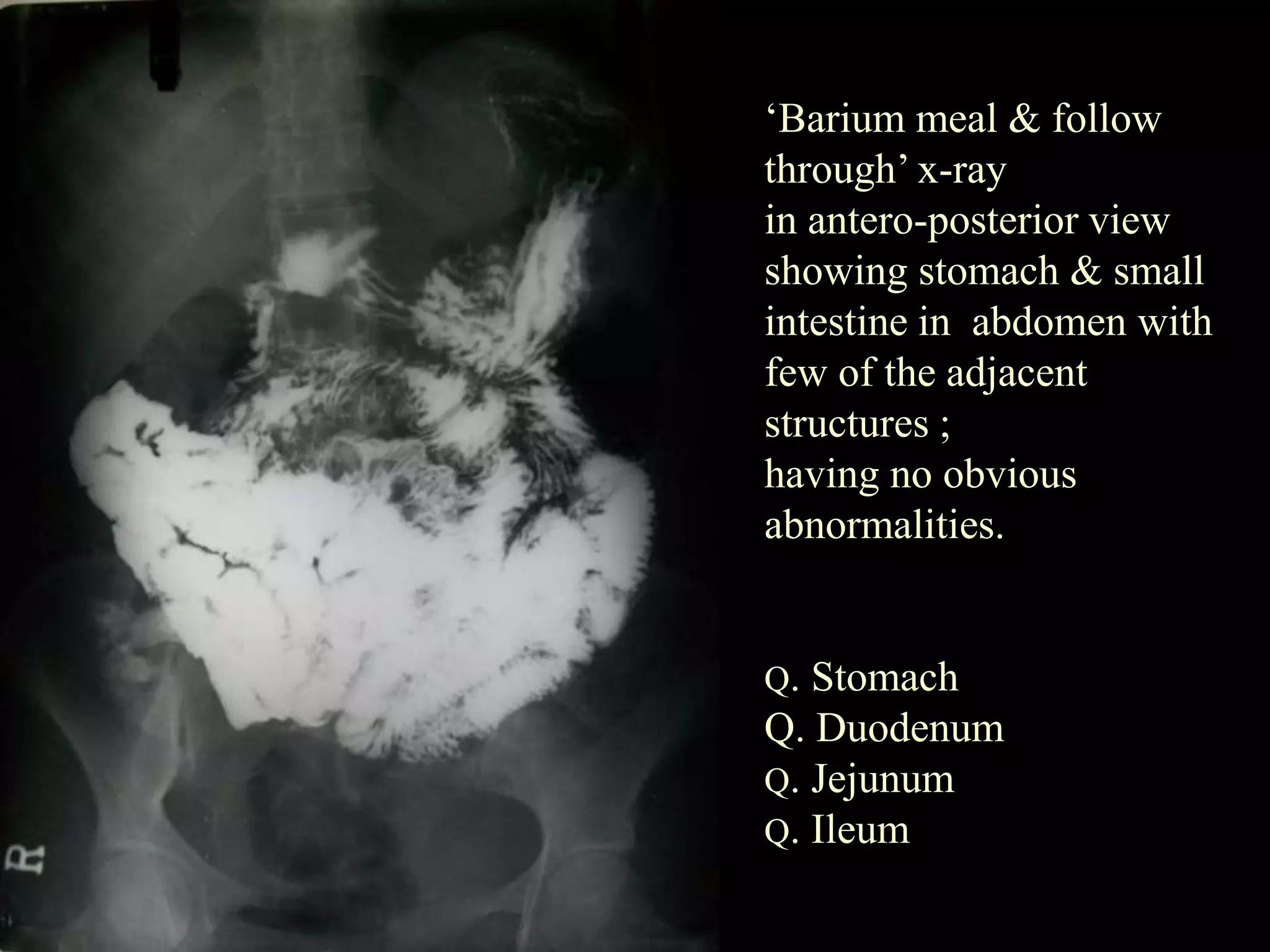 Radiology of abdomen | PPT