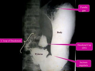 Radiology of abdomen | PPT