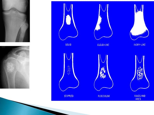 Radiology of Bone Tumours | PPTX