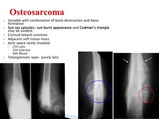 Radiology of Bone Tumours | PPT