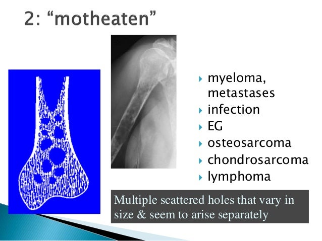 Radiology of Bone Tumours