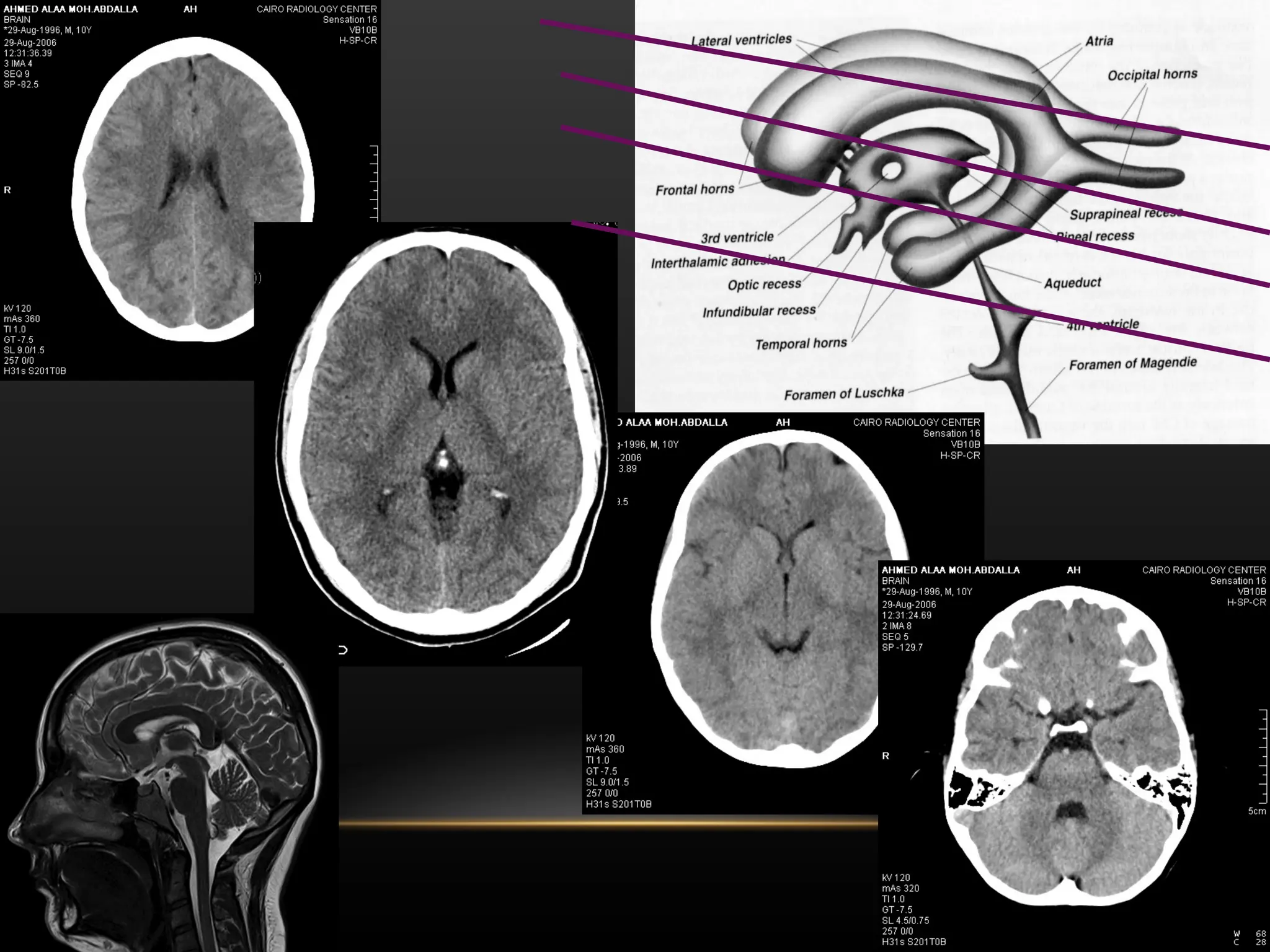Radiological anatomy of Brain and stroke imaging.ppt