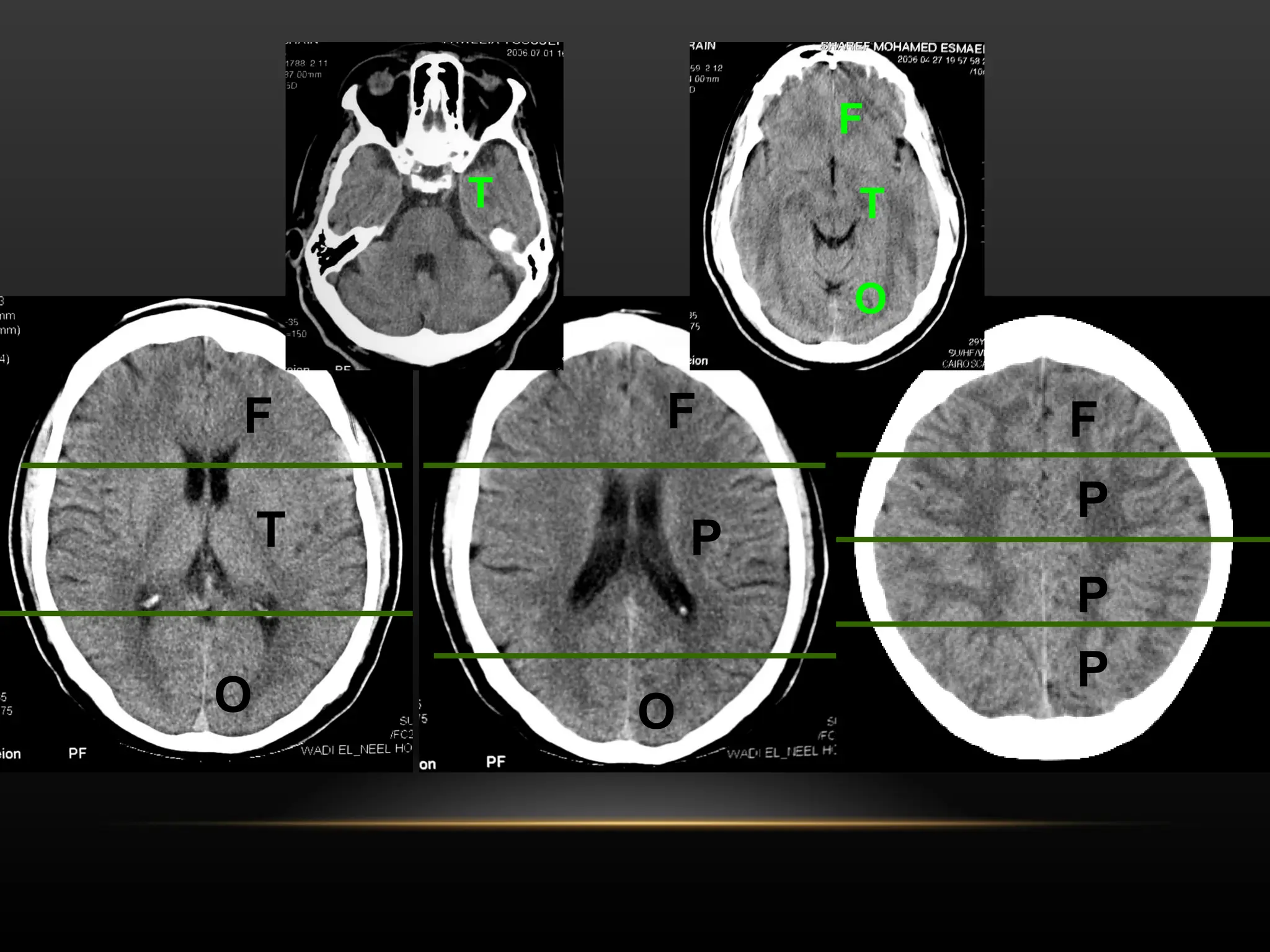 Radiological anatomy of Brain and stroke imaging.ppt
