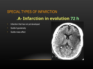 Radiological anatomy of Brain and stroke imaging.ppt