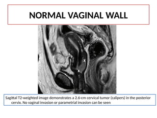 RADIOLOGY OF CANCER CERVIX BY DR KANHU CHARAN PATRO | PPTX