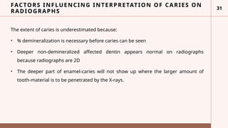 Comprehensive Radiology of Dental Caries: Diagnosis and Classification ...