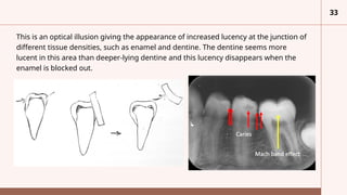 Comprehensive Radiology of Dental Caries: Diagnosis and Classification ...