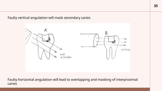 Comprehensive Radiology of Dental Caries: Diagnosis and Classification ...