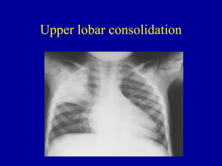 Radiology Of Chest 1st Year2 Ppt