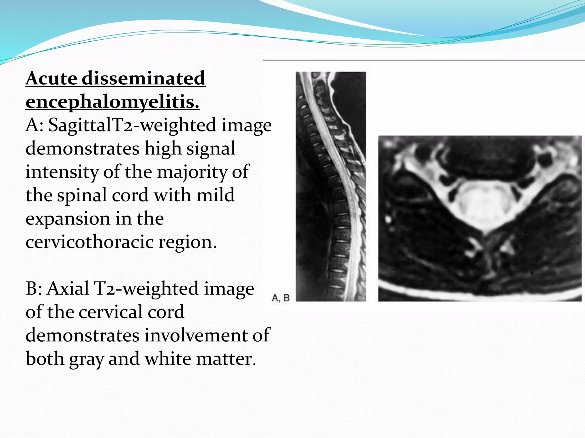 Radiology of demyelinating diseases | PPTX