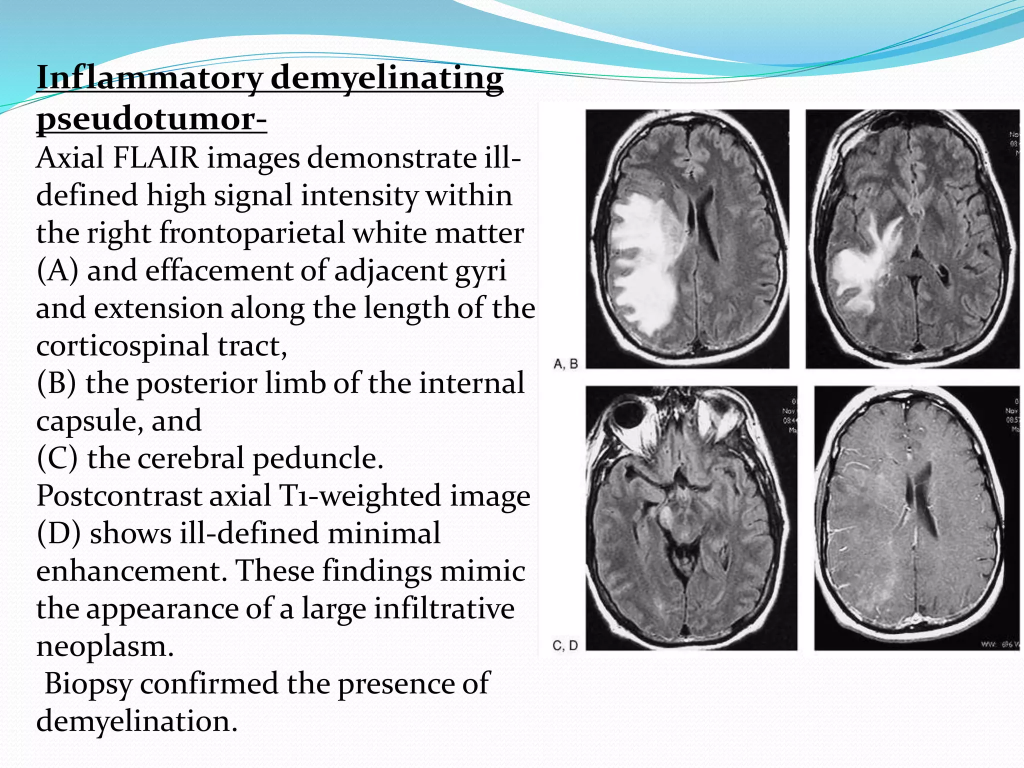 Radiology of demyelinating diseases | PPTX