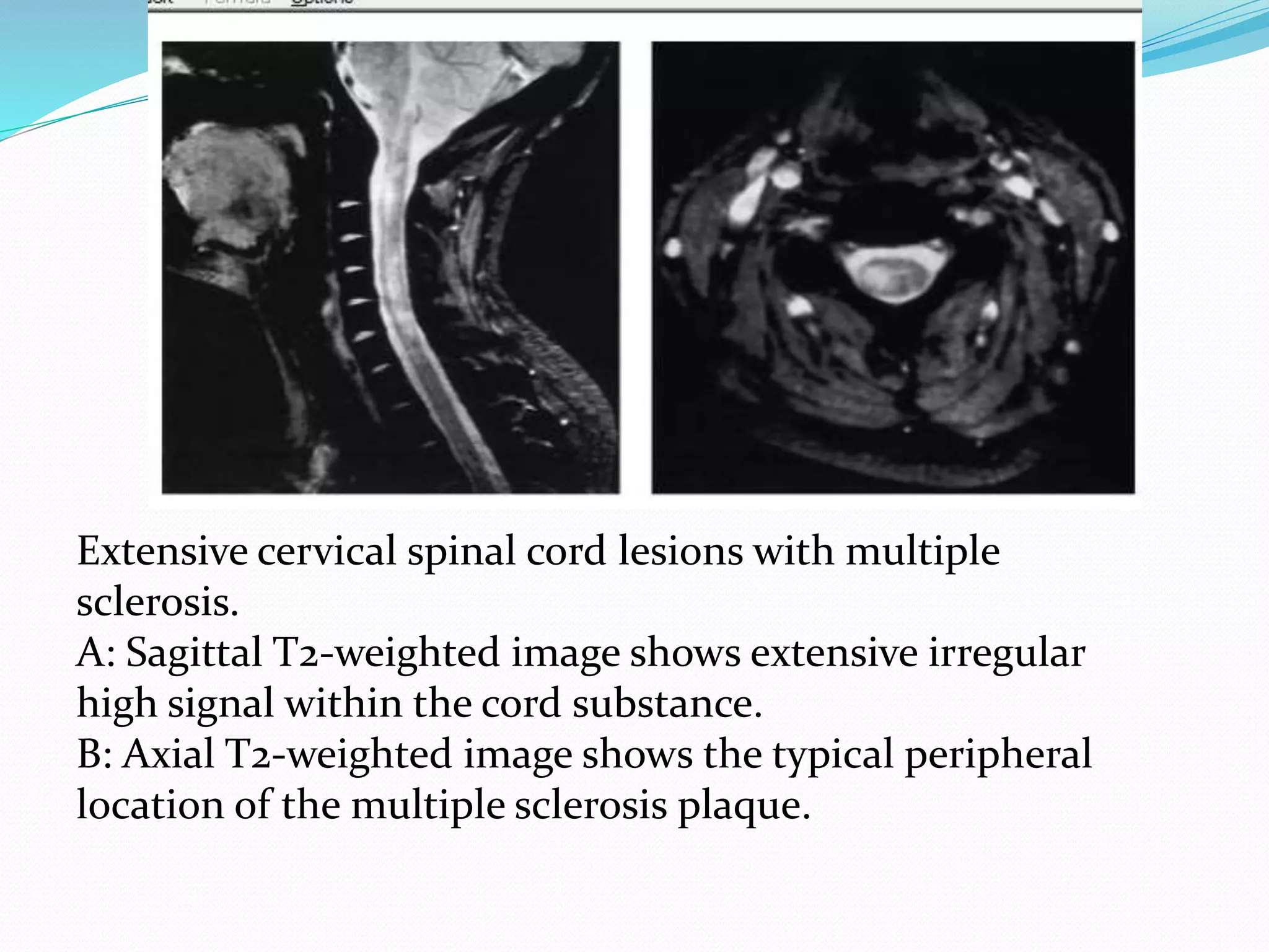 Radiology of demyelinating diseases | PPTX