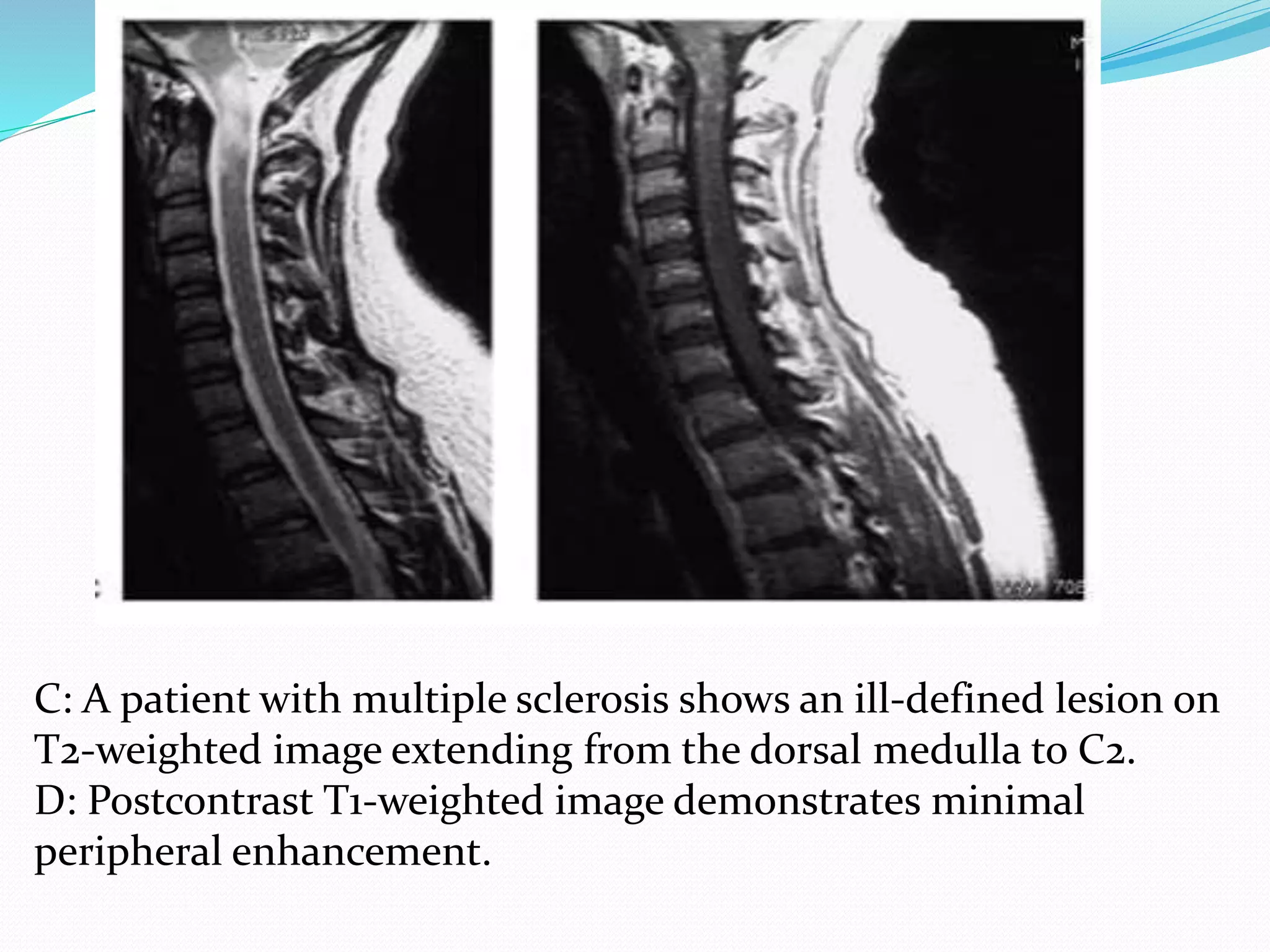 Radiology of demyelinating diseases | PPTX
