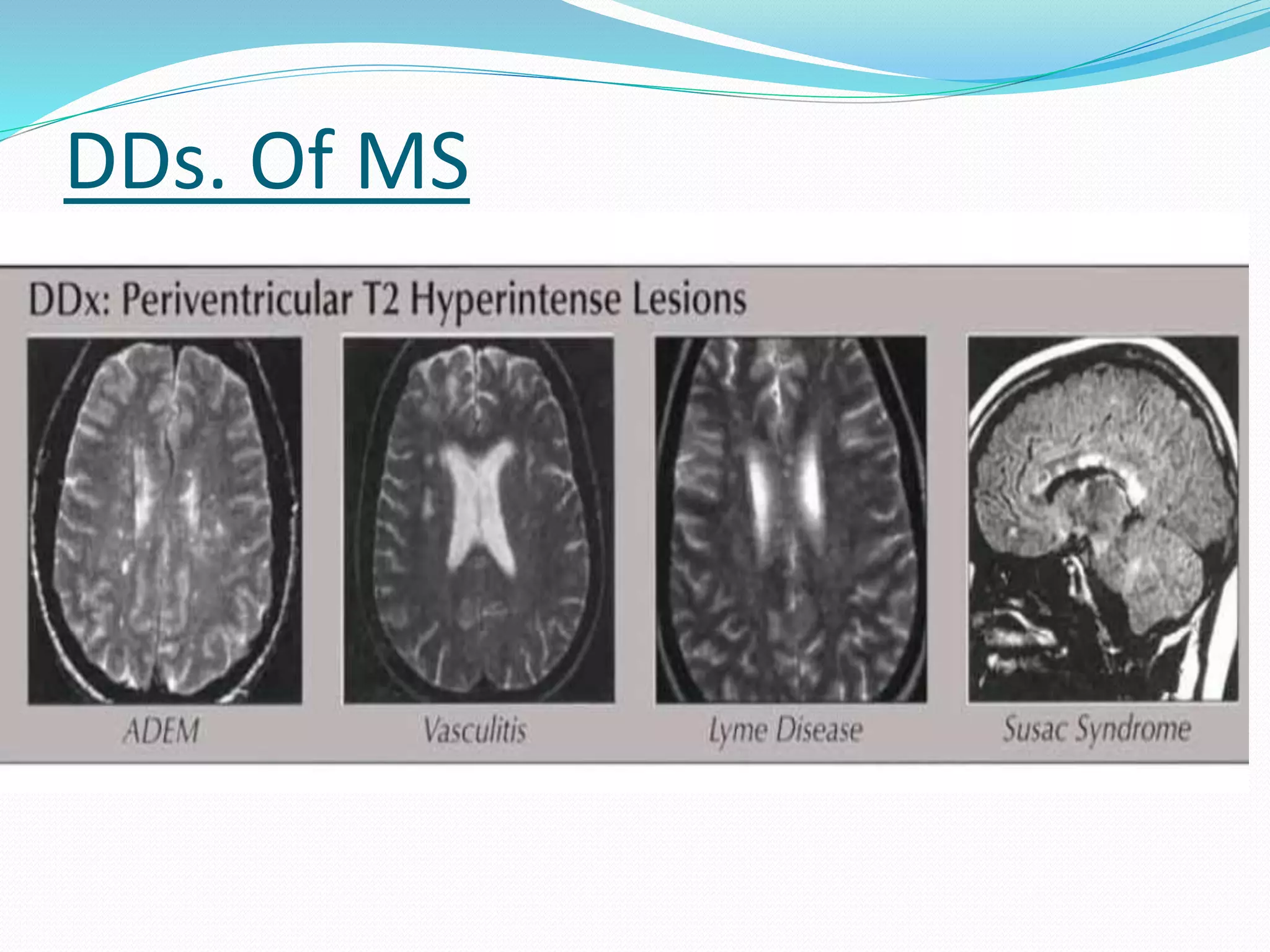 Radiology of demyelinating diseases | PPTX
