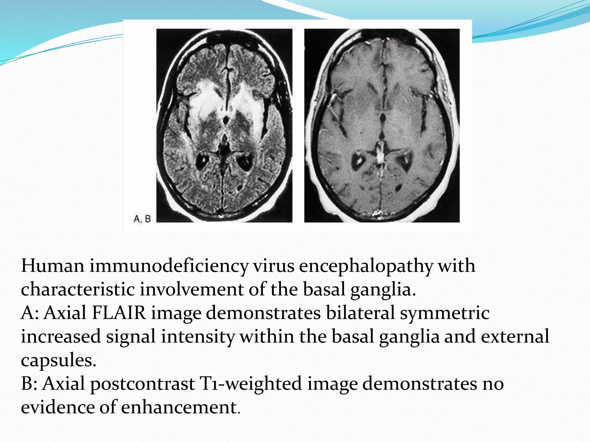 Radiology of demyelinating diseases | PPTX