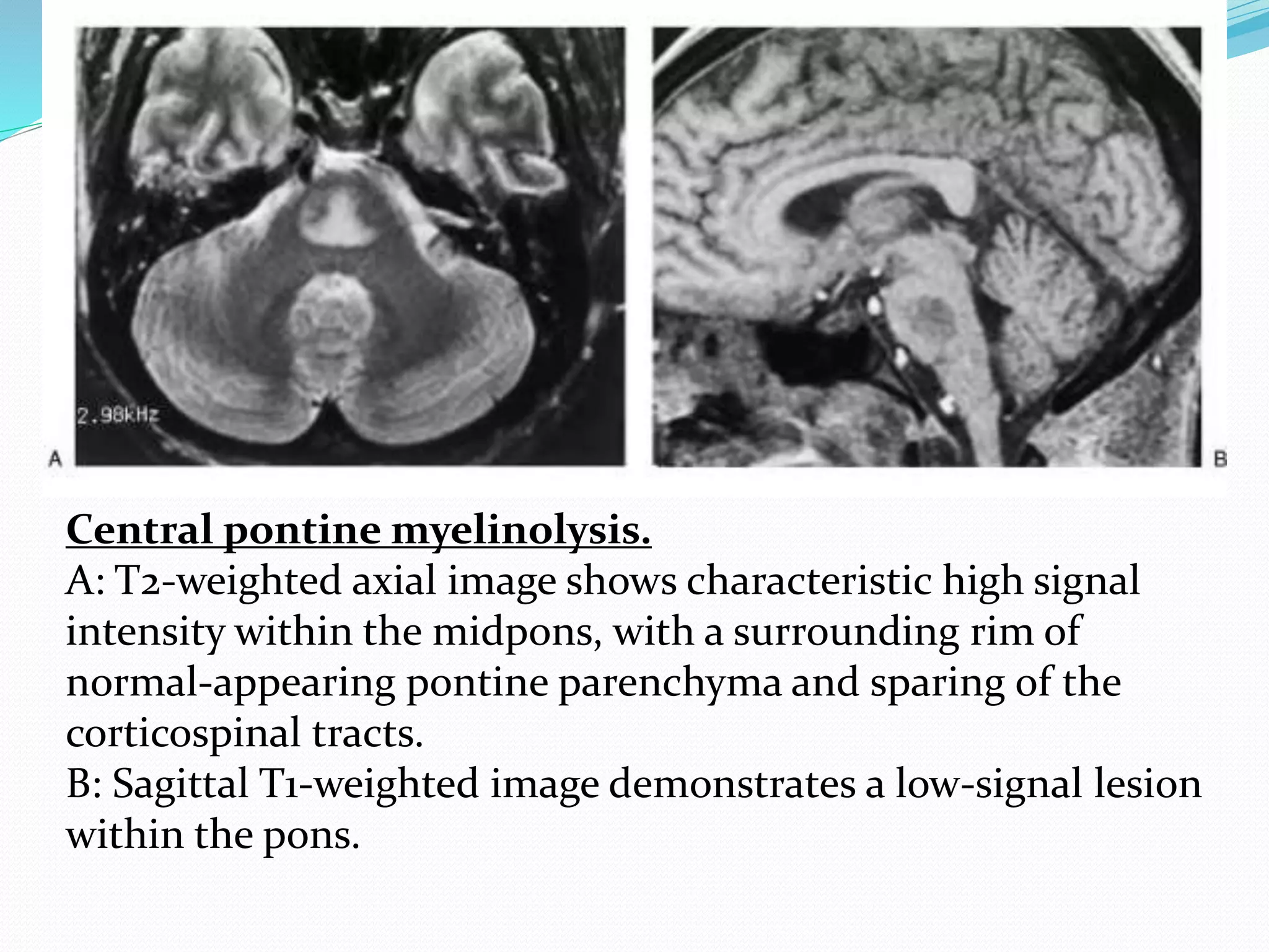 Radiology of demyelinating diseases | PPTX