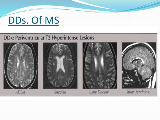 Radiology of demyelinating diseases | PPTX