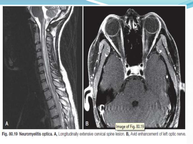 Radiology of demyelinating diseases | PPTX