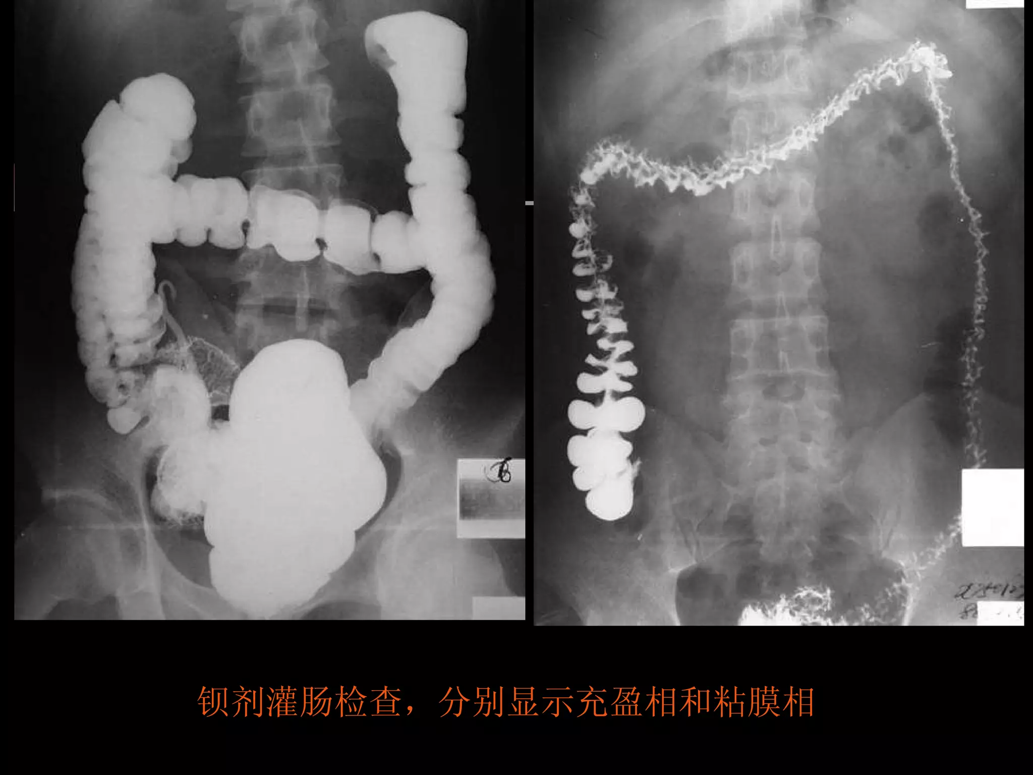 Radiology of digestive system | PPT