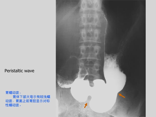 Radiology of digestive system | PPT | Digestive Disorders | Diseases ...
