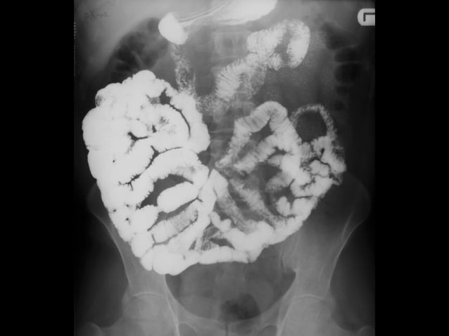 Radiology of digestive system | PPT | Digestive Disorders | Diseases ...