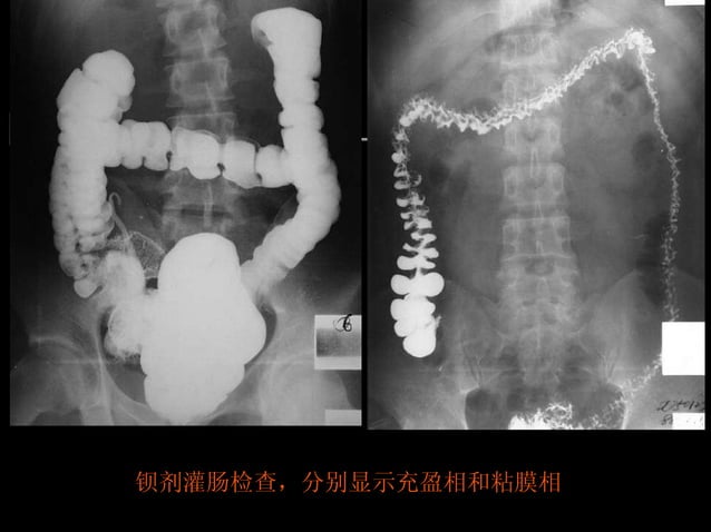 Radiology of digestive system | PPT | Digestive Disorders | Diseases ...