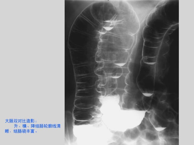 Radiology of digestive system | PPT | Digestive Disorders | Diseases ...