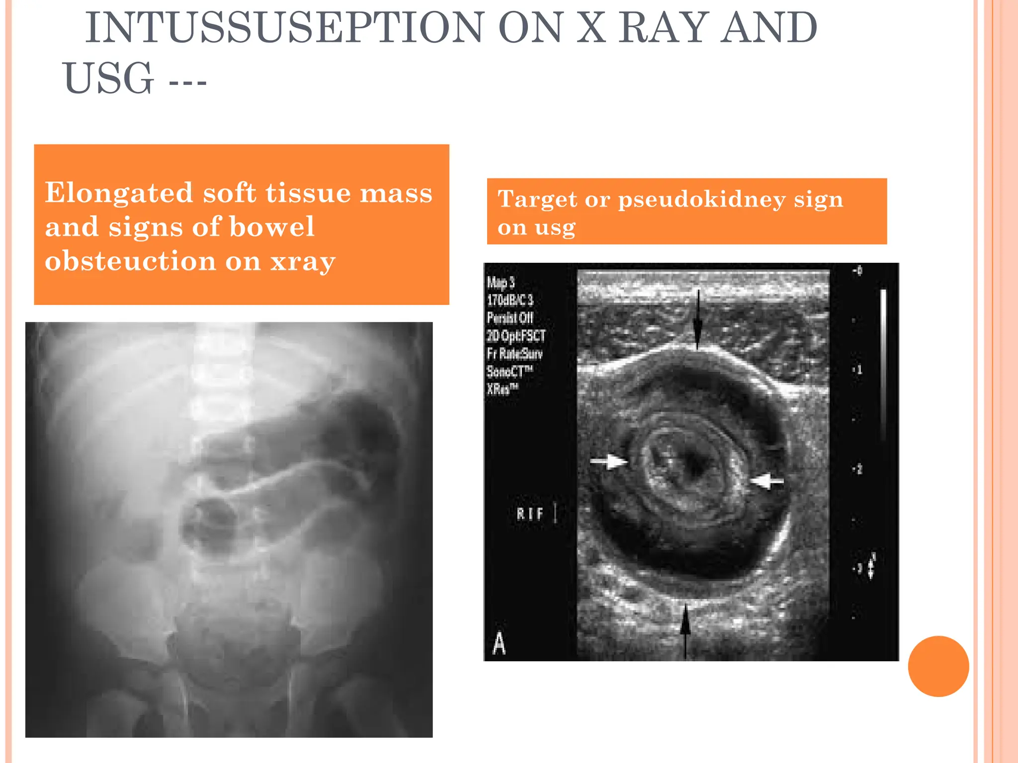 Radiology of gastro- intestinal tract.ppt