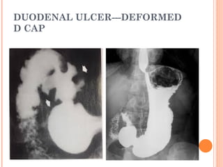 Radiology of gastro- intestinal tract.ppt