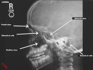 RADIOLOGY OF HEAD and NECK -Anatomy.pptx
